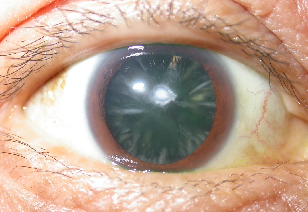 Cloudy Lens Cataract Eye Surgery LTD cloudy-lens-cataract-eye-surgery-ltd