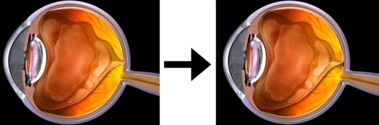 Vitreomacular Traction and Epiretinal Membrane-Eyesurgeryltd