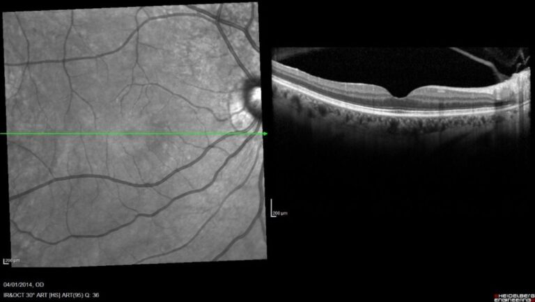 Vitreous Traction – Eye Surgery LTD