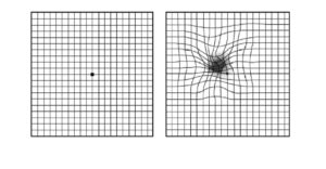 Age-Related Changes (Drusen & Macular Degeneration) - Eye Surgery LTD