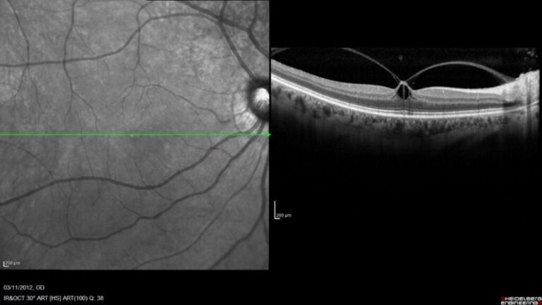 Vitreous Traction – Eye Surgery LTD