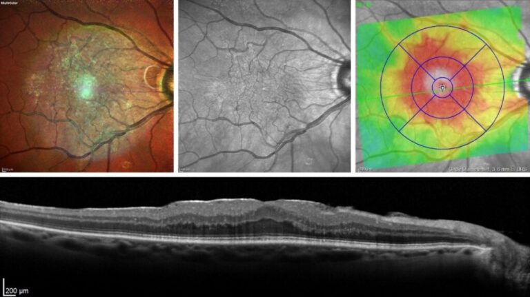 Vitreous Traction – Eye Surgery LTD