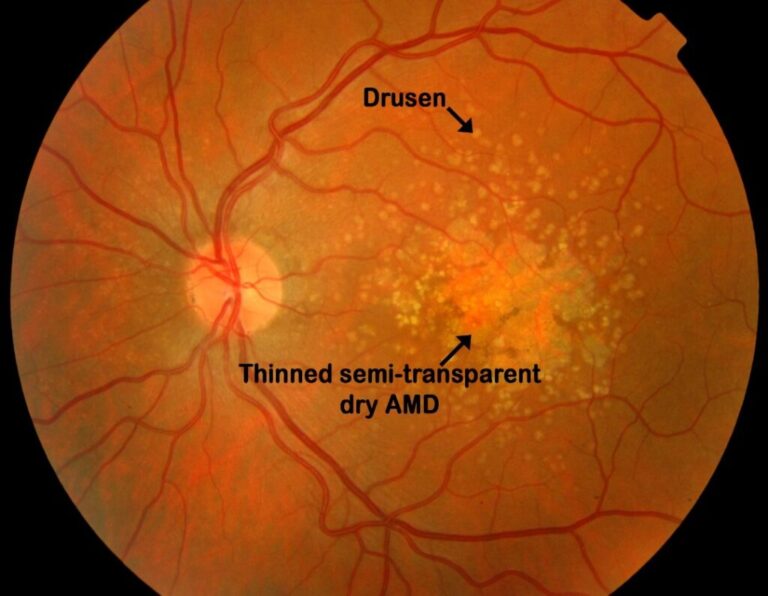 Age-Related Changes (Drusen & Macular Degeneration) - Eye Surgery LTD