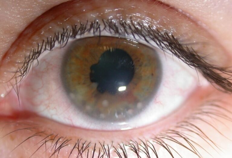 Iritis and Uveitis | Causes, Symptoms and Eye Treatment
